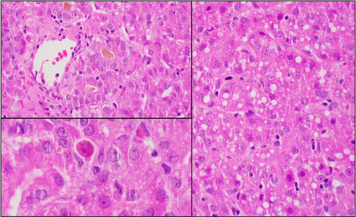 Case 1: Neonatal Cholestasis – Exploring Pediatric Pathology