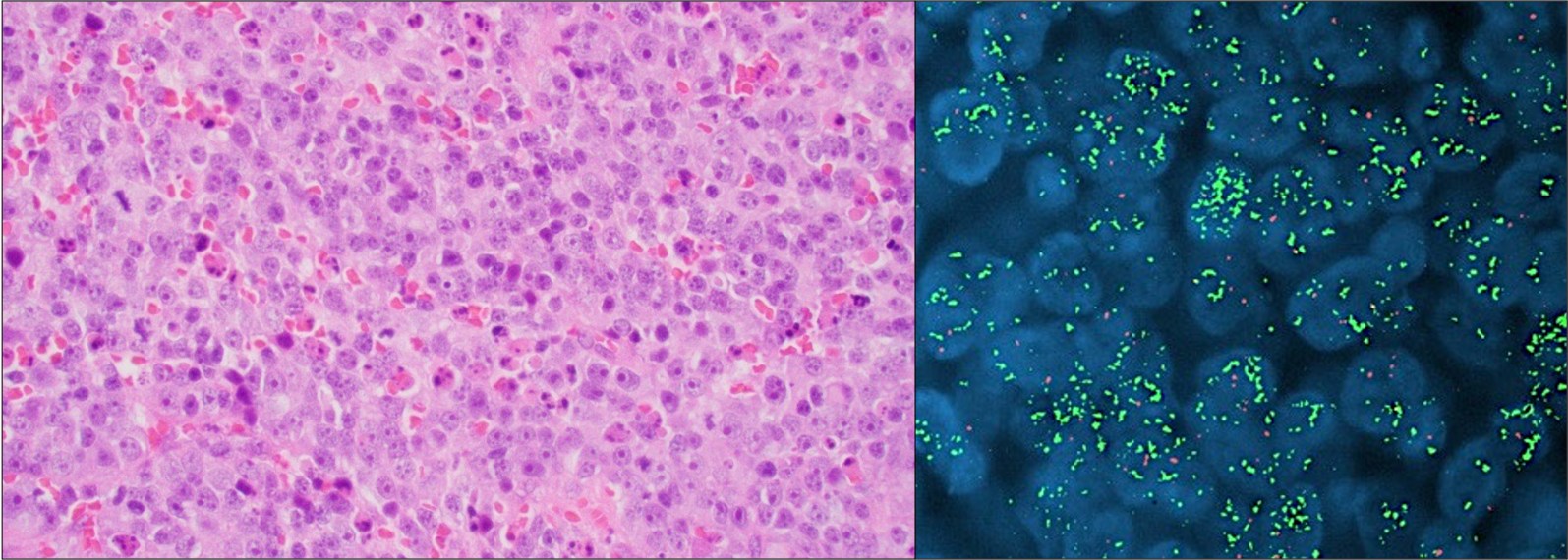 Neuroblastoma – Exploring Pediatric Pathology