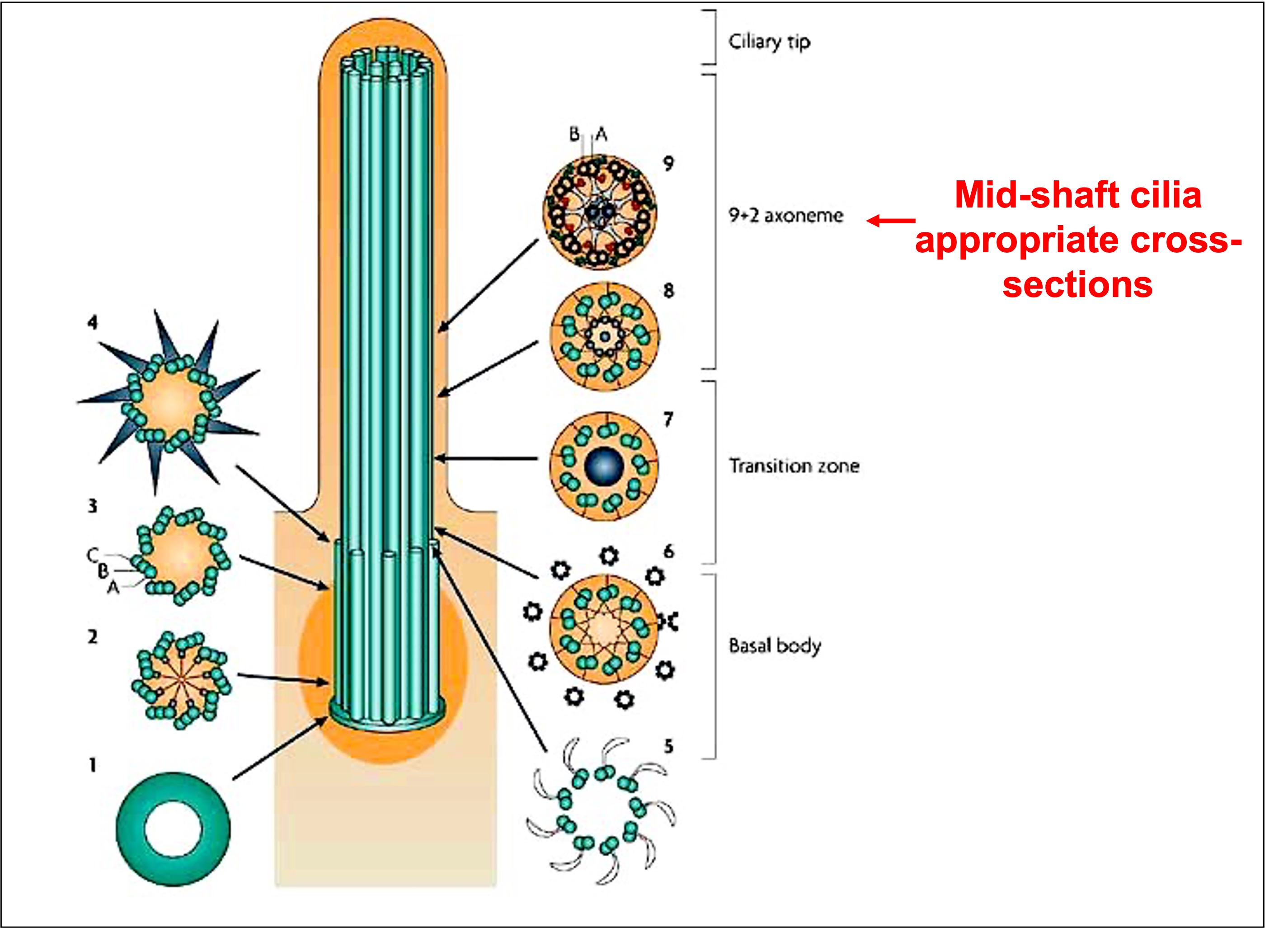 Primary Ciliary Dyskinesia (PCD) – Exploring Pediatric Pathology