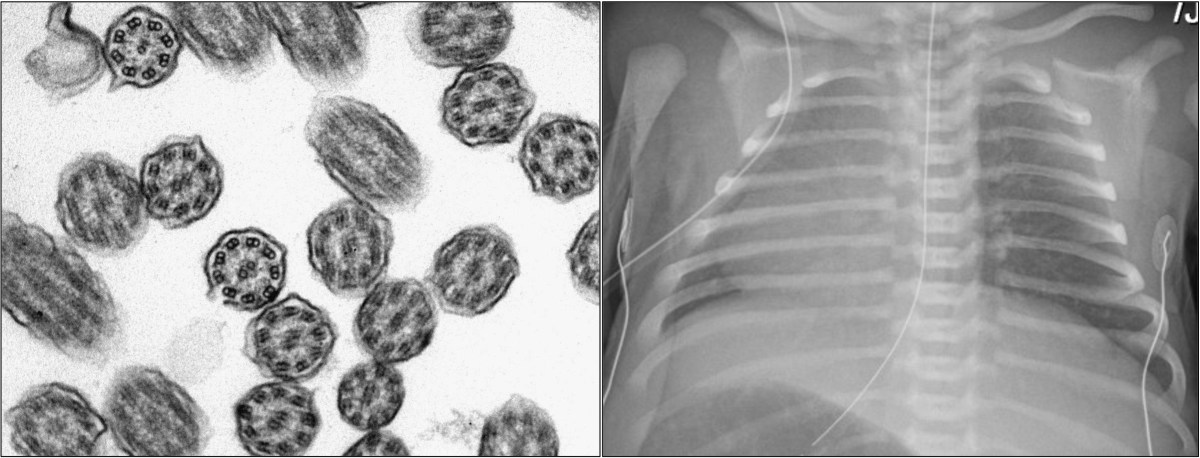 Primary Ciliary Dyskinesia Pcd Exploring Pediatric Pathology