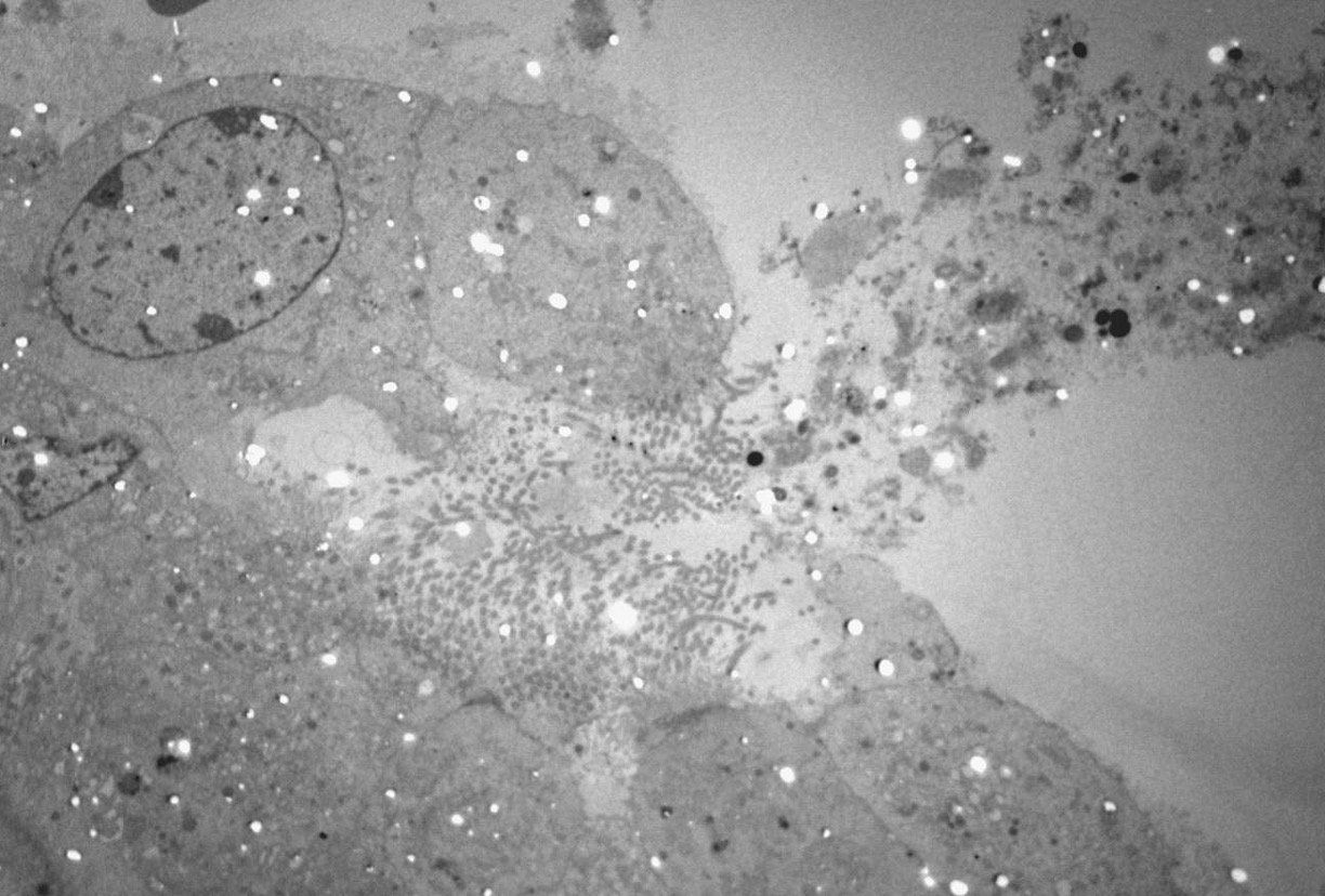 Primary Ciliary Dyskinesia (PCD) – Exploring Pediatric Pathology