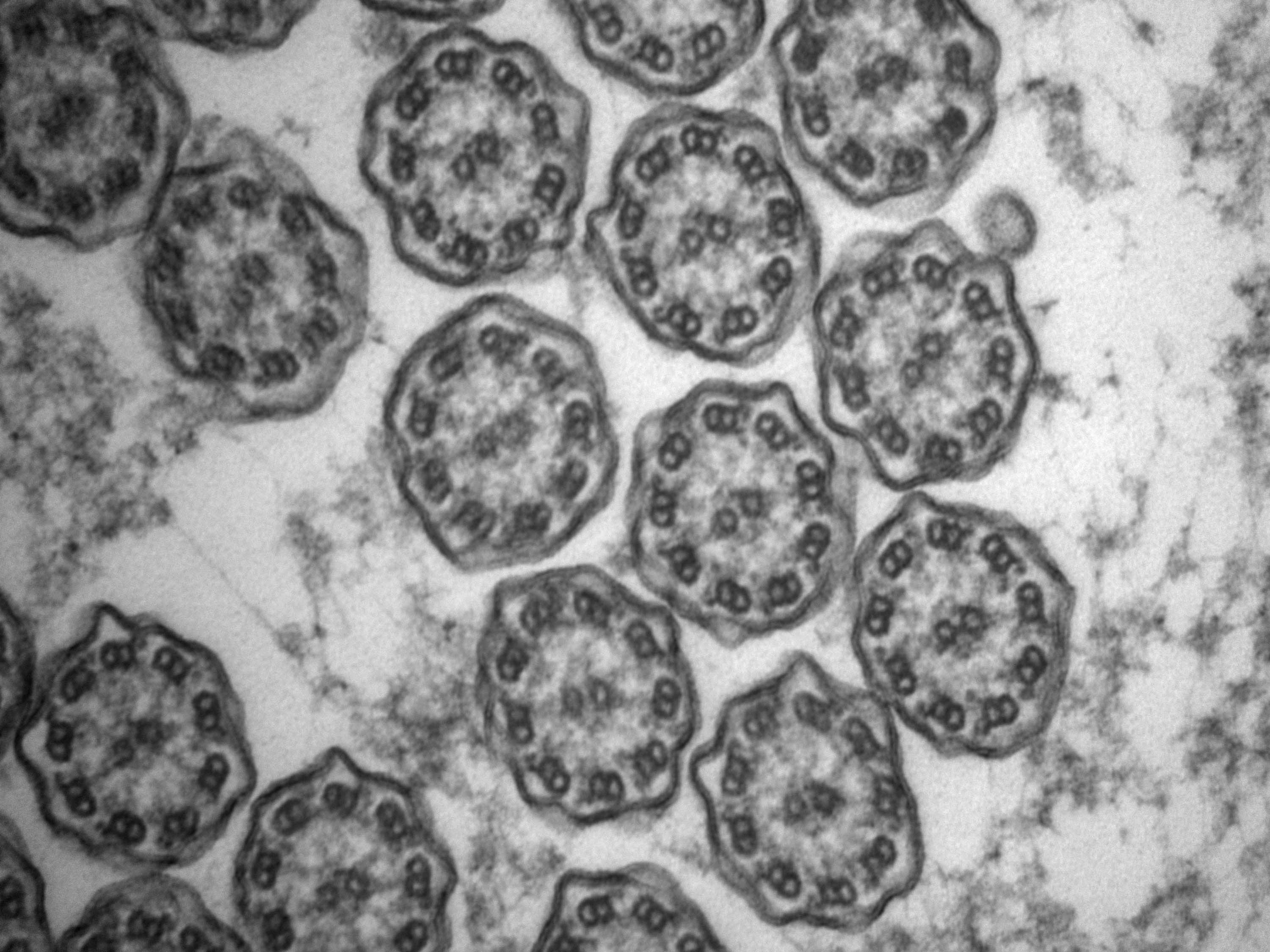 Primary Ciliary Dyskinesia (PCD) – Exploring Pediatric Pathology